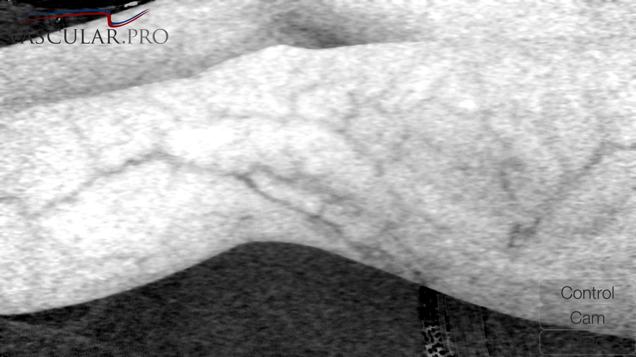 Vein Camera - Amato Software